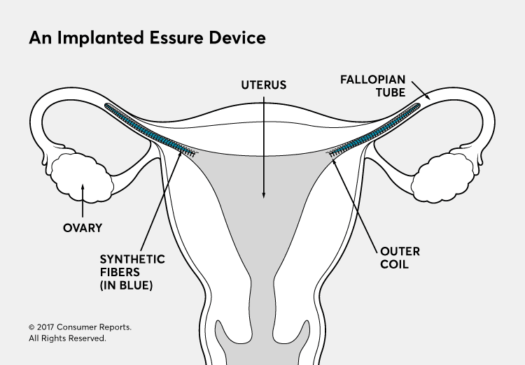 The Consumer's Guide to Essure Birth Control - Consumer Reports