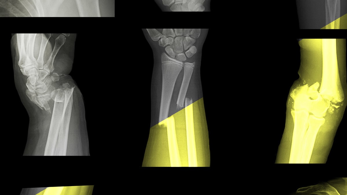 What Is A Clean Break In A Bone at Mark Byrd blog