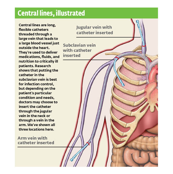 Hospitals and Their Prevention of Infections - Consumer Reports