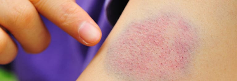 What It Means If You Bruise Easily - Consumer Reports